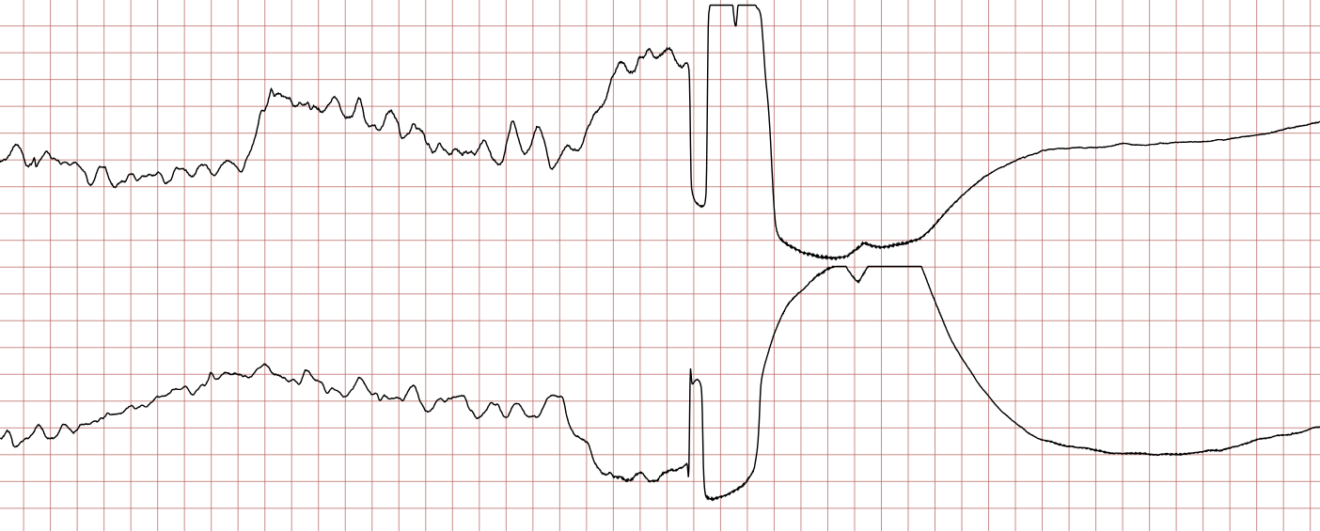 Ventricular tachycardia (VT): ECG criteria, causes, classification ...