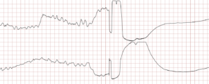 Ventricular tachycardia (VT): ECG criteria, causes, classification ...