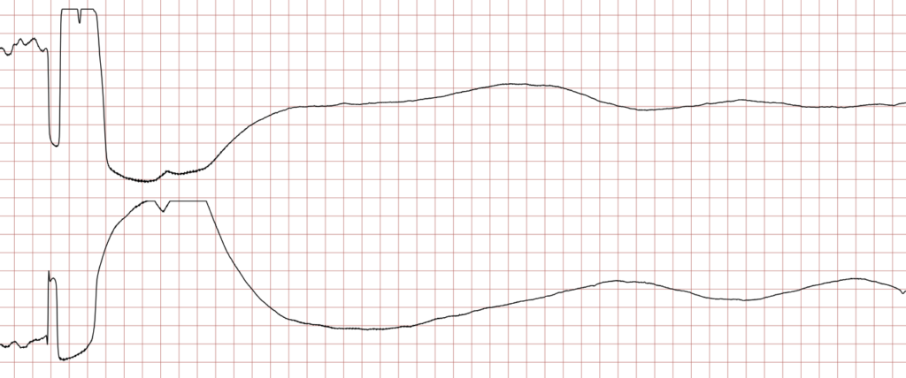 Ventricular tachycardia (VT): ECG criteria, causes, classification ...