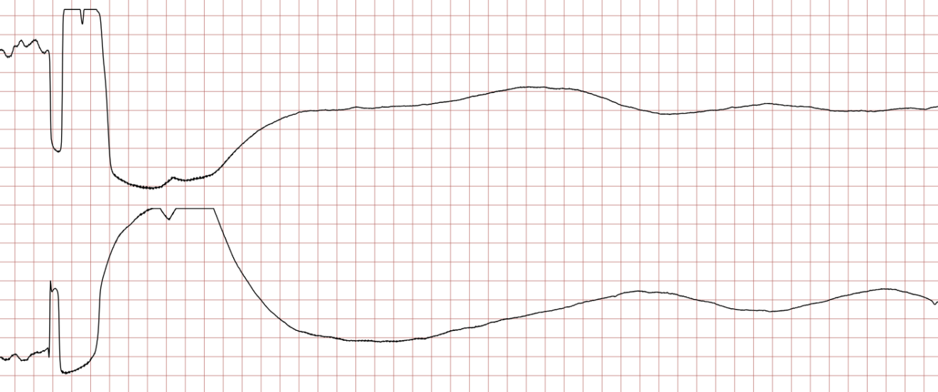 Ventricular tachycardia (VT): ECG criteria, causes, classification ...