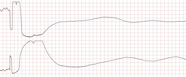 Ventricular tachycardia (VT): ECG criteria, causes, classification ...