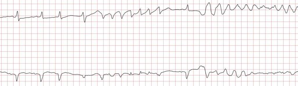 Sudden cardiac arrest (ventricular fibrillation, ventricular ...