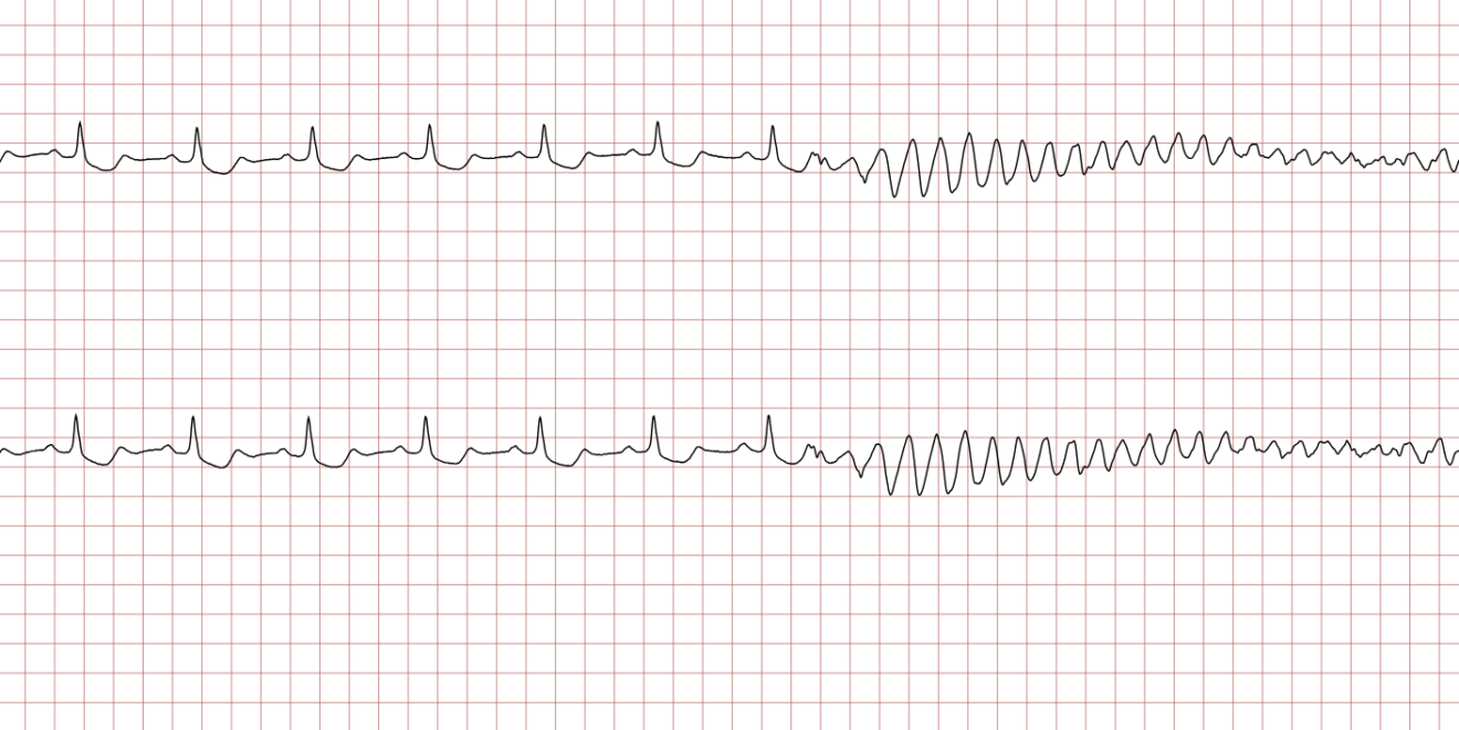 Ventricular fibrillation, pulseless electrical activity and sudden ...