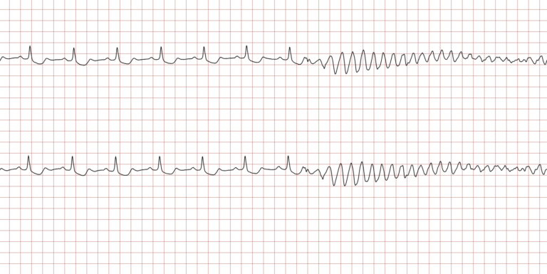 Ventricular fibrillation, pulseless electrical activity and sudden ...