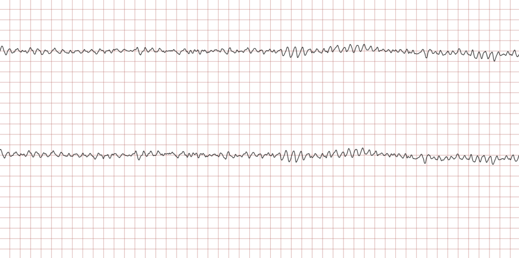 Ventricular fibrillation, pulseless electrical activity and sudden ...