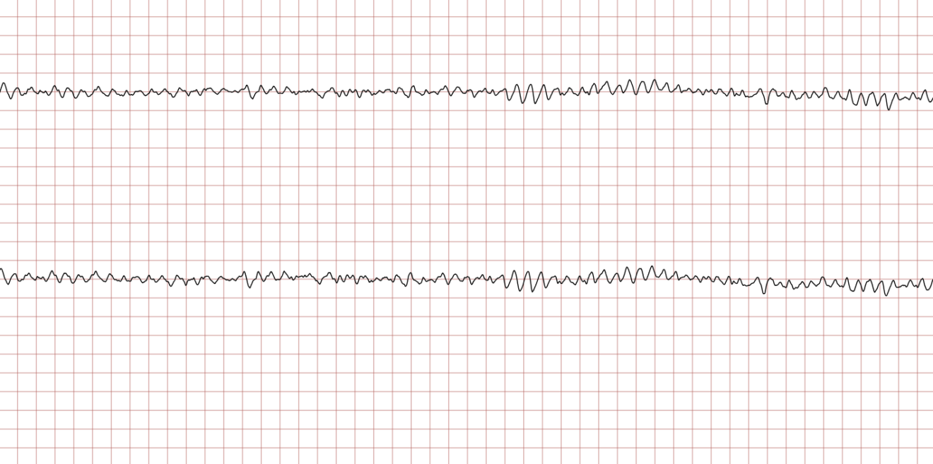 Ventricular fibrillation, pulseless electrical activity and sudden ...