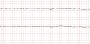 Ventricular fibrillation, pulseless electrical activity and sudden ...