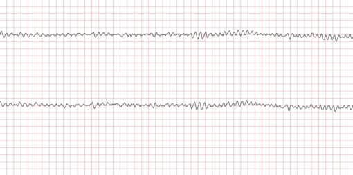 Ventricular fibrillation, pulseless electrical activity and sudden ...