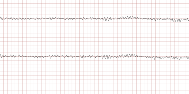 Ventricular fibrillation, pulseless electrical activity and sudden ...