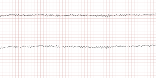 Ventricular fibrillation, pulseless electrical activity and sudden ...