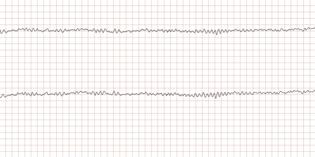 Ventricular fibrillation, pulseless electrical activity and sudden ...