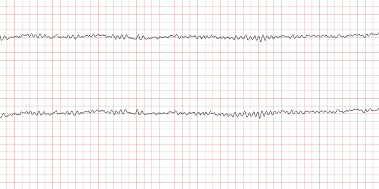 Ventricular fibrillation, pulseless electrical activity and sudden ...