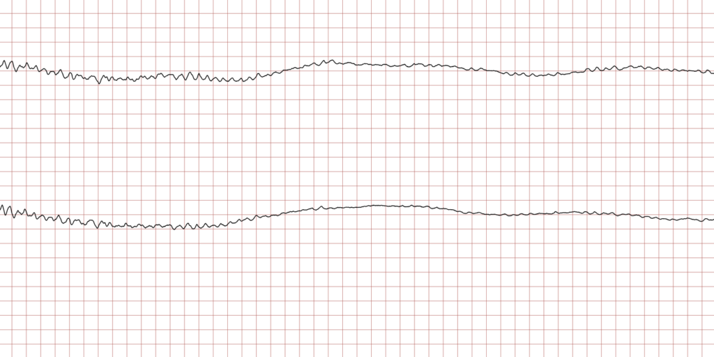 Ventricular fibrillation, pulseless electrical activity and sudden ...