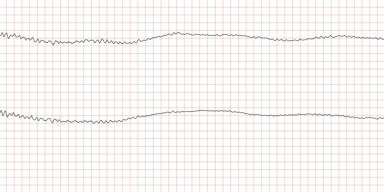 Ventricular fibrillation, pulseless electrical activity and sudden ...