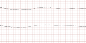 Ventricular fibrillation, pulseless electrical activity and sudden ...
