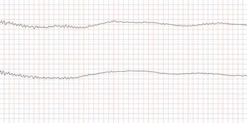 Ventricular fibrillation, pulseless electrical activity and sudden ...