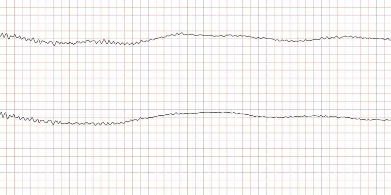 Ventricular fibrillation, pulseless electrical activity and sudden ...