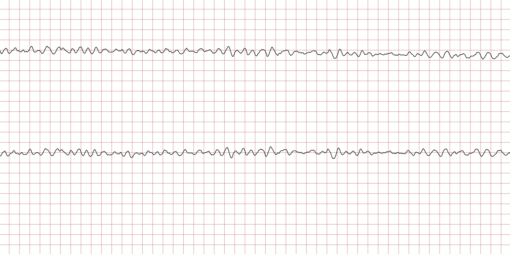 Ventricular fibrillation, pulseless electrical activity and sudden ...