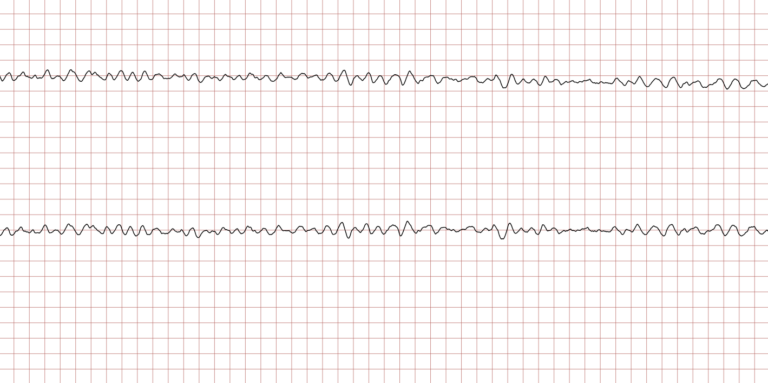 Ventricular fibrillation, pulseless electrical activity and sudden ...