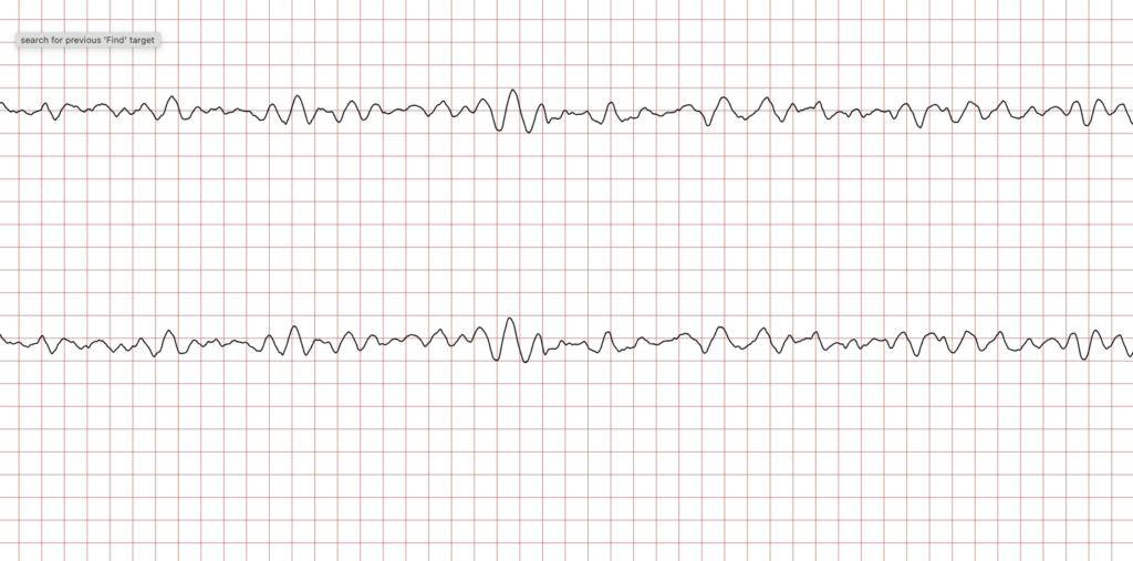 Sudden cardiac arrest (ventricular fibrillation, ventricular ...