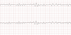 Ventricular fibrillation, pulseless electrical activity and sudden ...