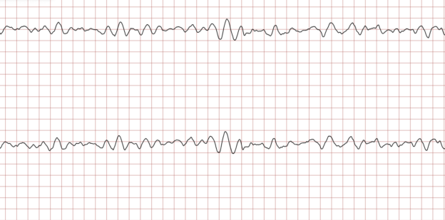 Ventricular fibrillation, pulseless electrical activity and sudden ...