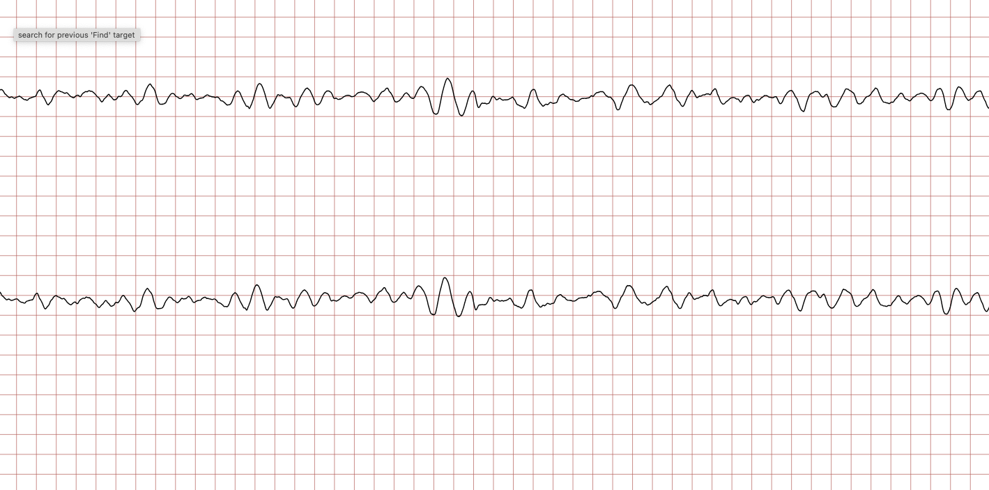 Sudden cardiac arrest (ventricular fibrillation, ventricular ...