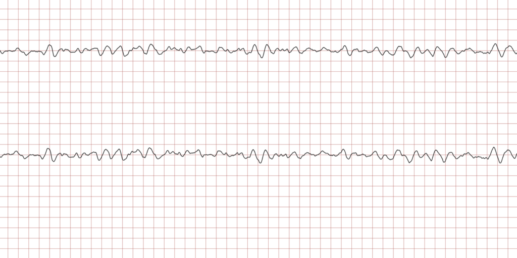 Ventricular fibrillation, pulseless electrical activity and sudden ...