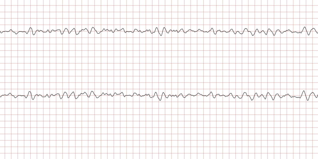 Ventricular fibrillation, pulseless electrical activity and sudden ...