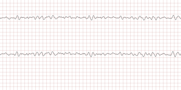 Ventricular fibrillation, pulseless electrical activity and sudden ...