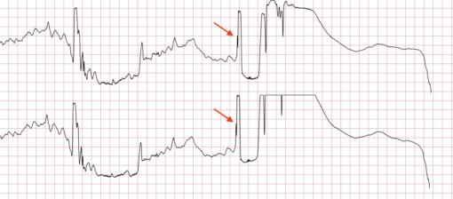 Ventricular fibrillation, pulseless electrical activity and sudden ...