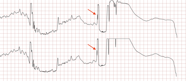 Ventricular fibrillation, pulseless electrical activity and sudden ...
