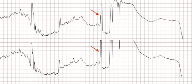 Ventricular fibrillation, pulseless electrical activity and sudden ...