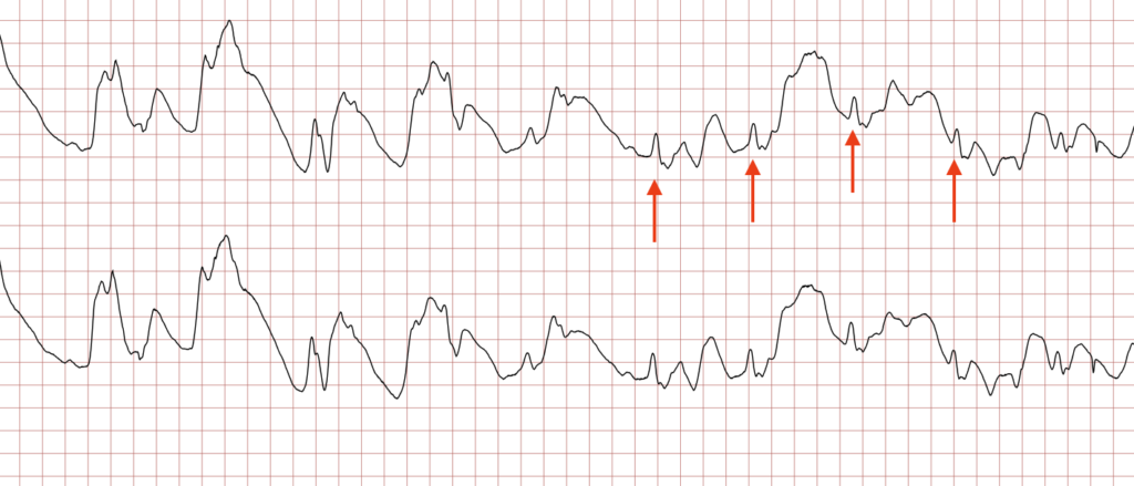 Ventricular fibrillation, pulseless electrical activity and sudden ...