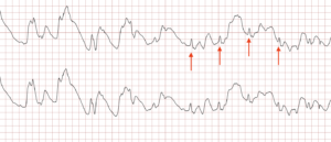 Ventricular fibrillation, pulseless electrical activity and sudden ...