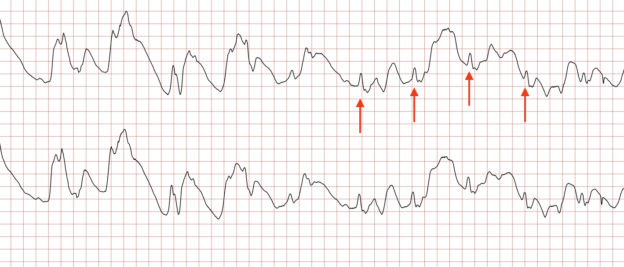Ventricular fibrillation, pulseless electrical activity and sudden ...