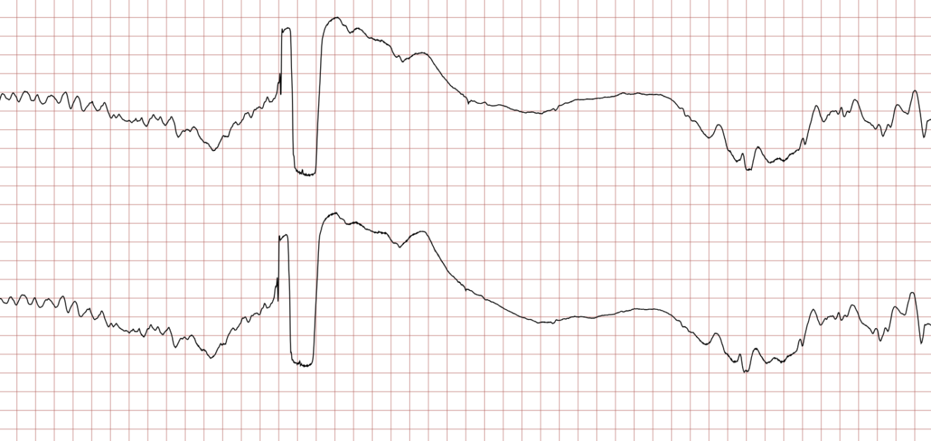 Ventricular fibrillation, pulseless electrical activity and sudden ...
