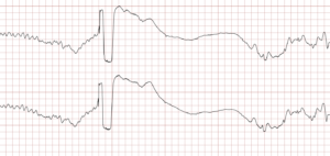 Ventricular fibrillation, pulseless electrical activity and sudden ...