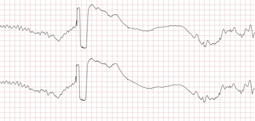 Ventricular fibrillation, pulseless electrical activity and sudden ...