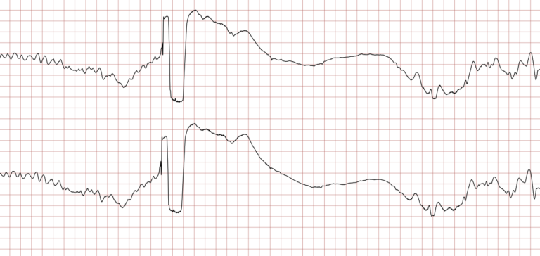 Ventricular fibrillation, pulseless electrical activity and sudden ...