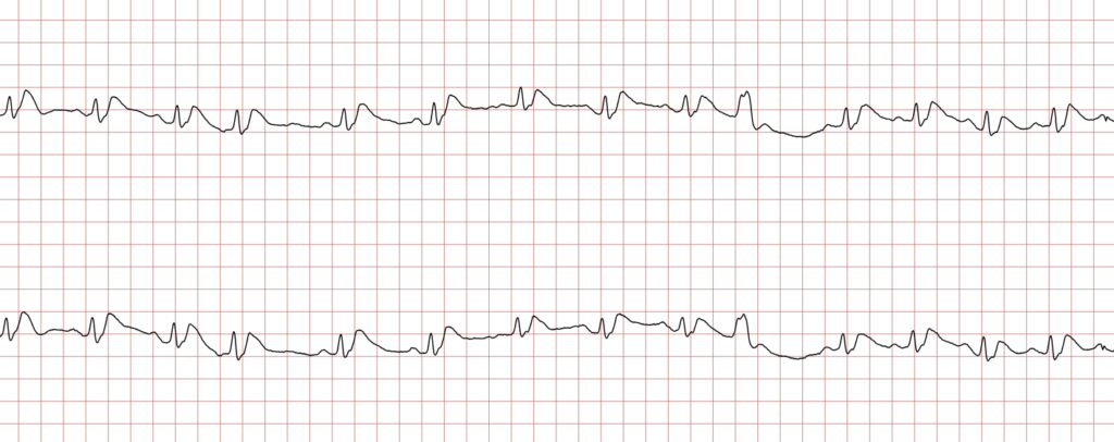 Ventricular fibrillation, pulseless electrical activity and sudden ...