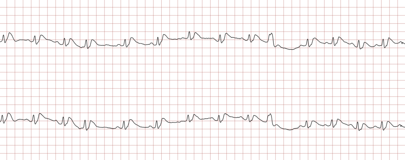 Ventricular fibrillation, pulseless electrical activity and sudden ...