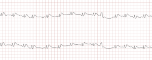 Ventricular fibrillation, pulseless electrical activity and sudden ...