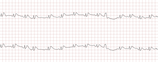 Ventricular fibrillation, pulseless electrical activity and sudden ...