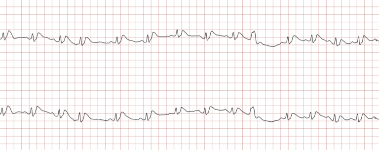 Ventricular fibrillation, pulseless electrical activity and sudden ...