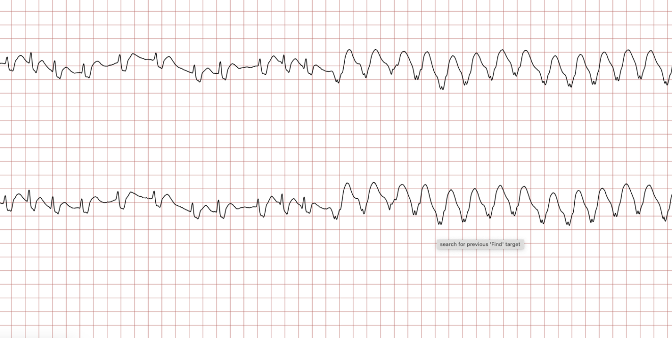 Ventricular fibrillation, pulseless electrical activity and sudden ...