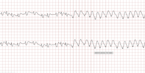 Ventricular fibrillation, pulseless electrical activity and sudden ...
