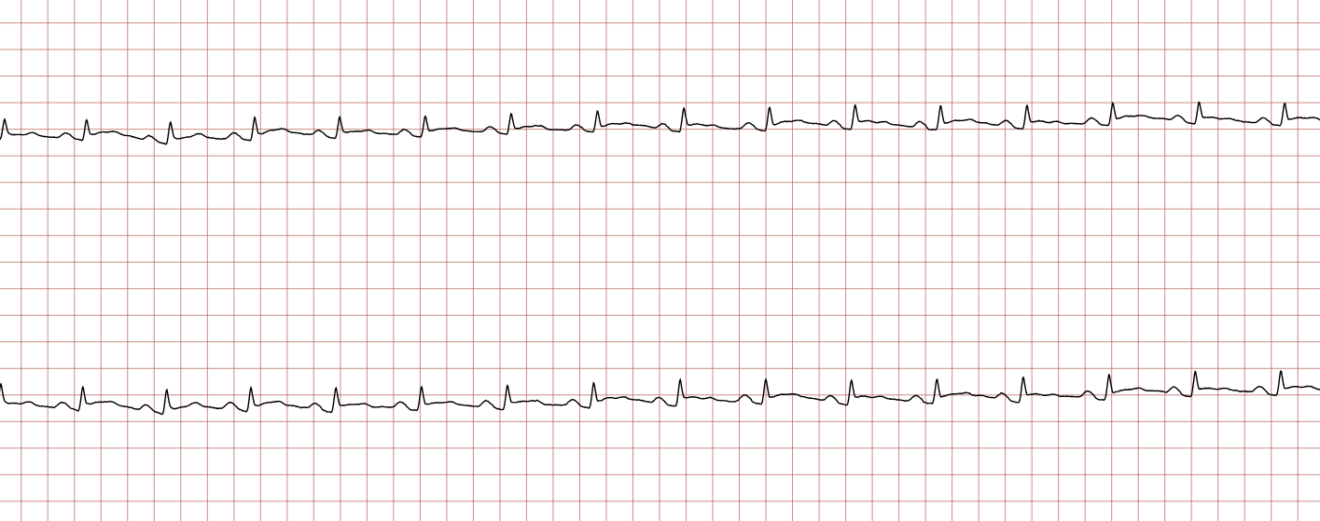 Ventricular fibrillation, pulseless electrical activity and sudden ...
