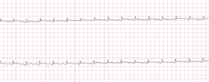 Ventricular fibrillation, pulseless electrical activity and sudden ...