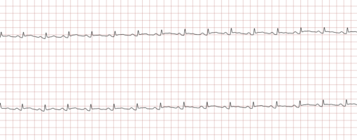 Ventricular fibrillation, pulseless electrical activity and sudden ...